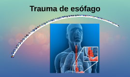 Trauma de esofago by on Prezi