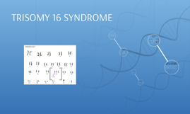 TRISOMY 16 SYNDROME by Nicolas Mejia on Prezi