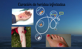 curacion de heridas infectadas by sarahi calderon sanchez on Prezi