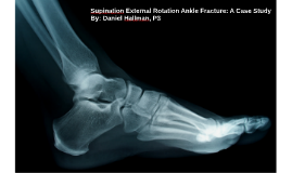 Lateral Talar Shift by Daniel Hallman on Prezi