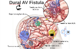 Dural AV Fistula by N F on Prezi