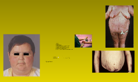 Cushing-Syndrom/ Morbus Cushing by Amy Betterwine on Prezi