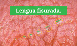 leucoedema. by romero itzel on Prezi