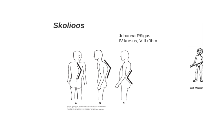 Skolioos by Johanna Rõigas on Prezi