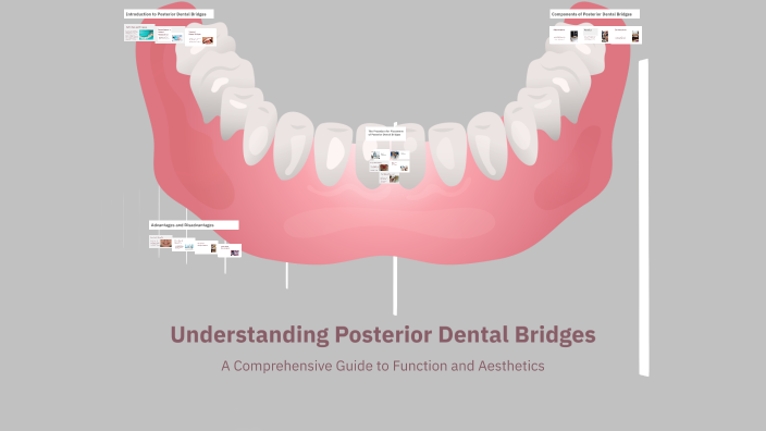 Understanding Posterior Dental Bridges by Mhmd Kadri on Prezi