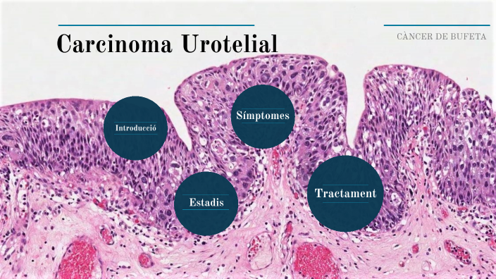 Carcinoma urotelial by Hana Miller on Prezi
