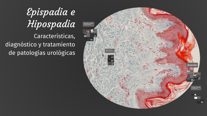 Epispadia e Hipospadia by Alma Cristina Hernandez Huertas on Prezi