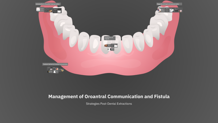 Management of Oroantral Communication and Fistula by Ahmed Elsefy on Prezi