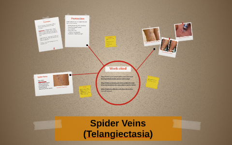 Spider Veins (Telangiectasia) by Courtney Sullivan on Prezi