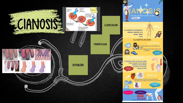 CIANOSIS-FISIOPATOLOGIA-CLASIFICACION by Tania on Prezi