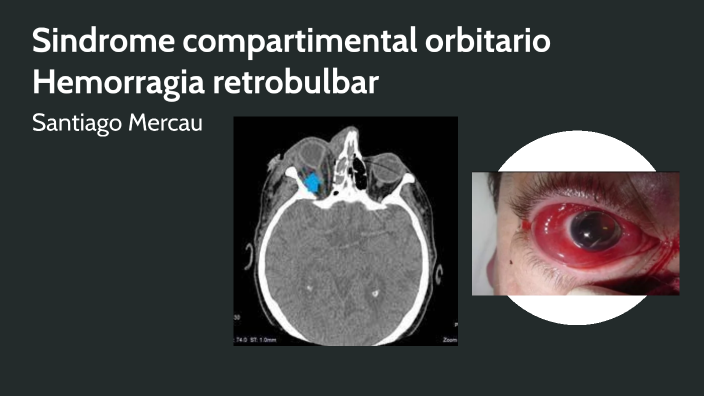Hemorragia retrobulbar by Santiago Mercau on Prezi