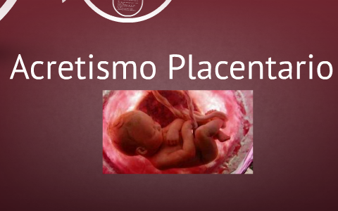 Acretismo Placentario by Jorge Cortes on Prezi