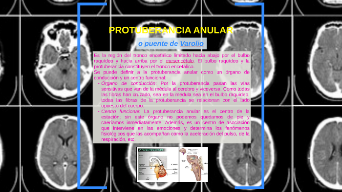 PROTUBERANCIA ANULAR by Den Rodriguez on Prezi