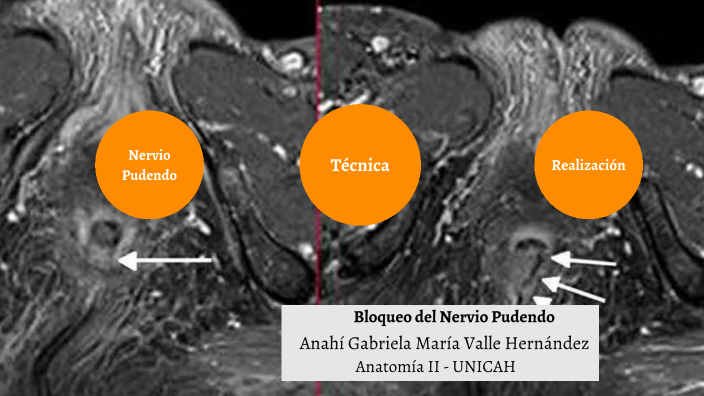 Bloqueo del nervio Pudendo by Anahí Valle on Prezi