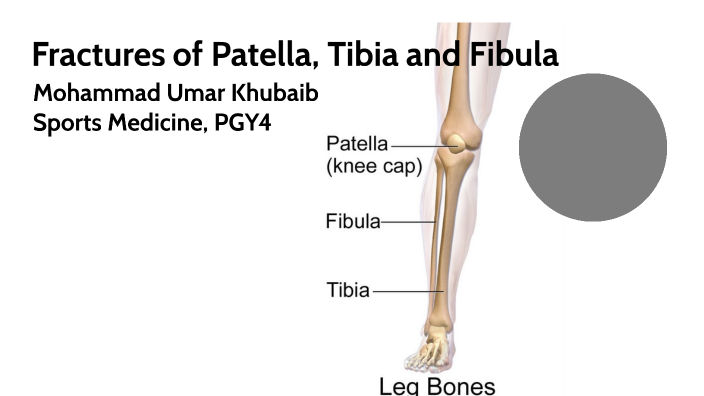 Patella, Tibia, Fibula fractures by Mohammad Khubaib on Prezi