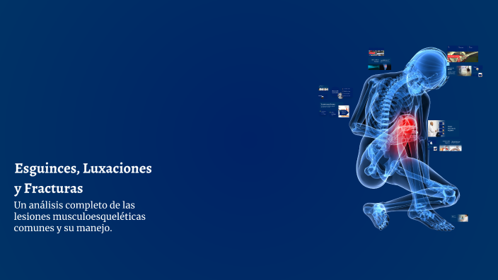 Esguinces, Luxaciones y Fracturas by Nés Vásquez on Prezi