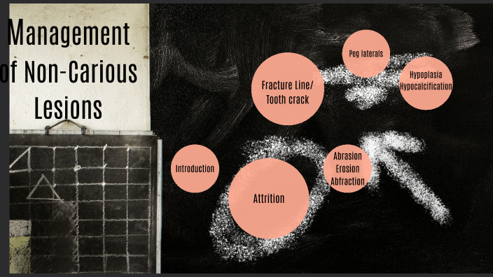 management of non-carious lesions eva by Eva Osama on Prezi