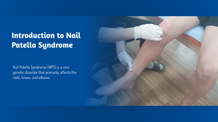 Understanding Nail Patella Syndrome by Emmanuel Defran Hernandez on Prezi