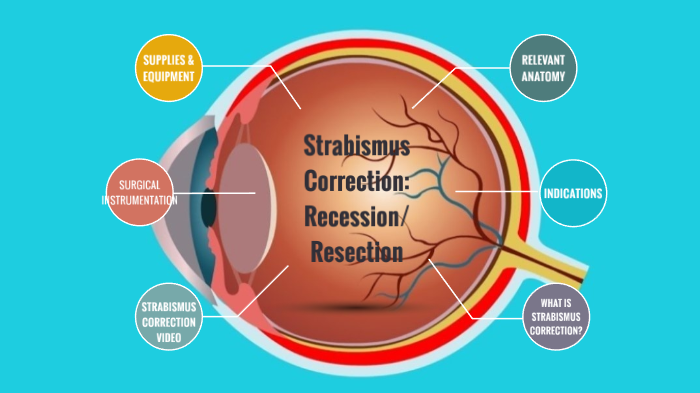 Strabismus Correction: Recession/Resection by Adriana Hernandez on Prezi