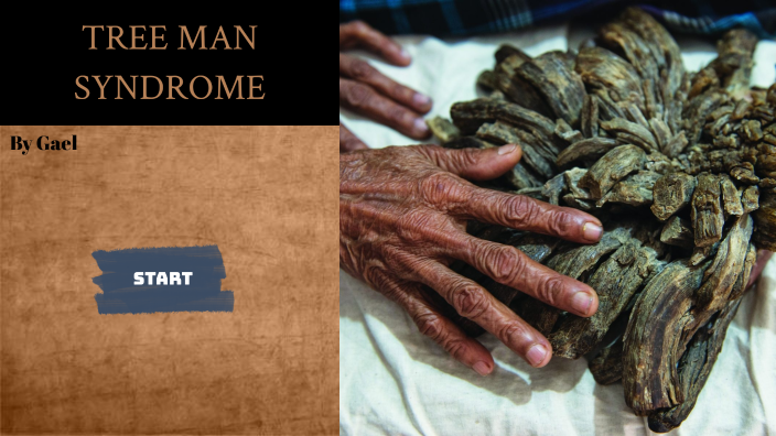 Tree Man Syndrome by GAEL LECHUGA on Prezi