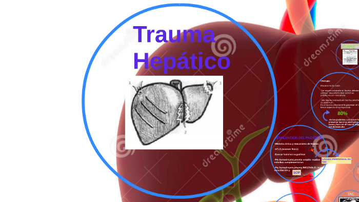 Trauma Hepático by Tatiana Sequeira on Prezi