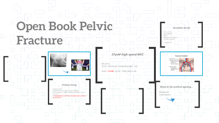 Open Book Pelvic Fracture by Ramya Kondaveeti on Prezi