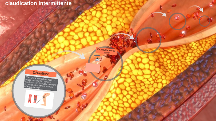 claudication intermittent by hana chahlal on Prezi