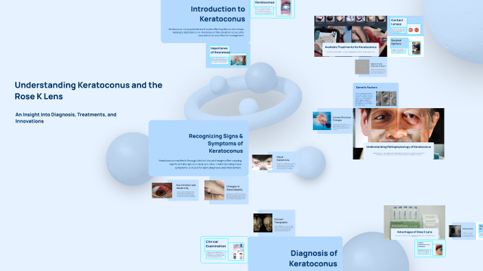 Understanding Keratoconus and Rose K Lens by Anjali Sarkar on Prezi