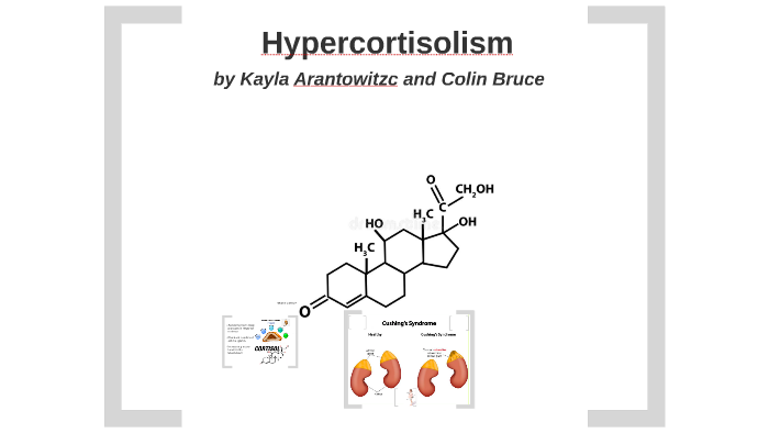 Hypercortisolism by Cj Bruce on Prezi