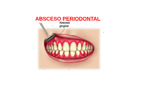 ABSCESO PERIODONTAL by Adriana Chinchilla on Prezi