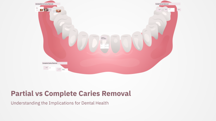 Partial vs Complete Caries Removal by خالد عيد on Prezi