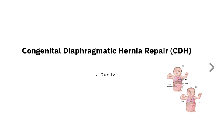 Congenital Diaphragmatic Hernia Repair (CDH) by on Prezi