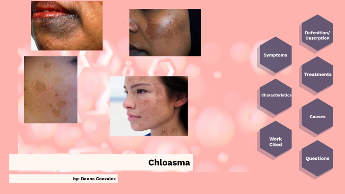 Chloasma by Danna Gonzalez on Prezi