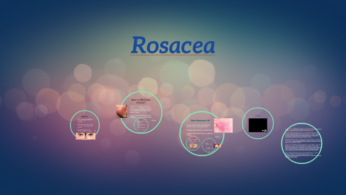 Rosacea by Emma Middendorf on Prezi