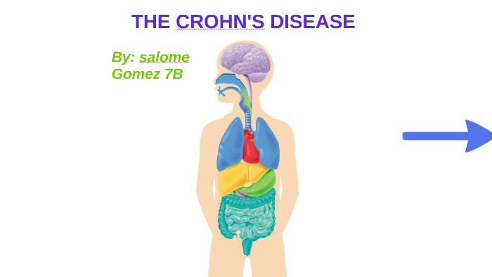 THE CROHN'S DISEASE by Salome Gomez on Prezi