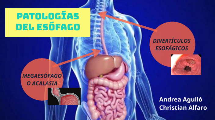 patologías esófago by Michael Estewart on Prezi