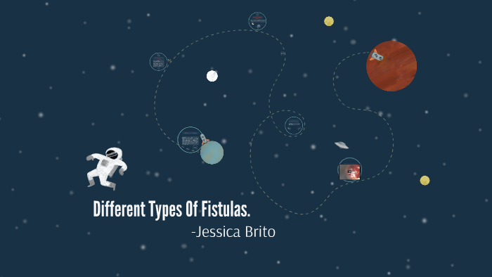 Different Types Of Fistulas. by Jessica Brito on Prezi