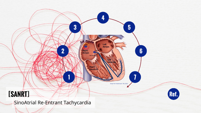 (SANRT) Sinoatrial Re-Entrant Tachycardia by Theresa Nguyen on Prezi