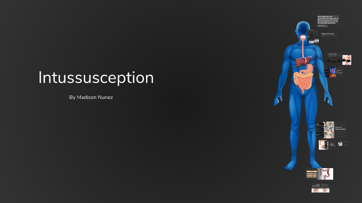 Understanding Intussusception: Causes, Symptoms, and Treatments by ...