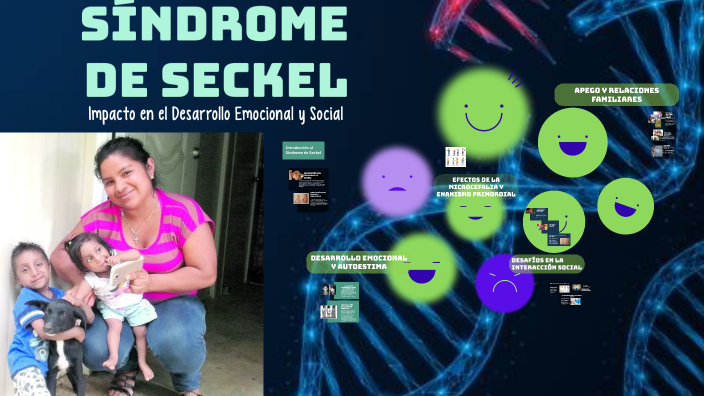 Síndrome de Seckel by Jose Fernandez on Prezi