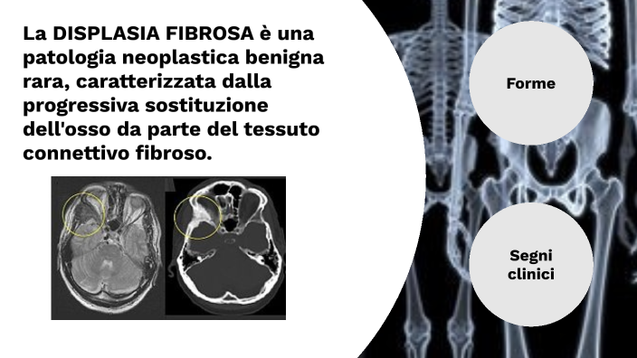 Displasia Fibrosa by giulia paolini on Prezi