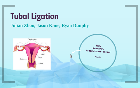 Tubal Ligation by Julian Zhou on Prezi