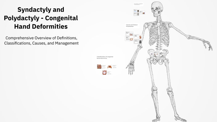 Syndactyly and Polydactyly - Congenital Hand Deformities by Victoria ...
