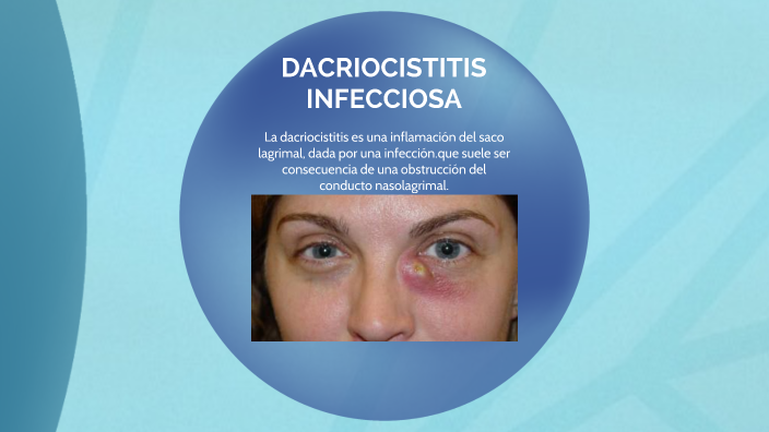 Dacriocistitis infecciosa by Gina Acosta on Prezi