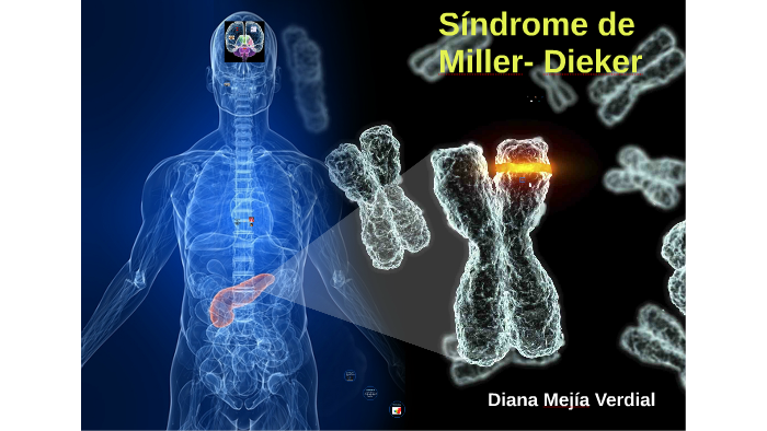 Sìndrome de Miller- Dieker by diana mejia on Prezi