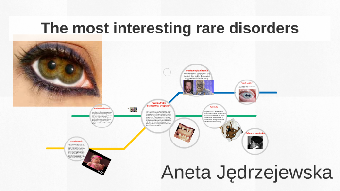 The most interesting rare disorders by Aneta Jędrzejewska on Prezi