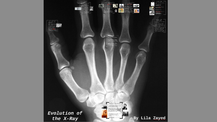 Evolution of the X-Ray by Lilac Zayood