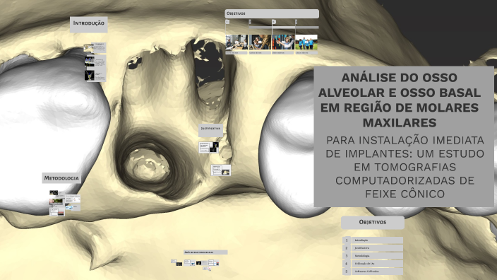 ANÁLISE DO OSSO ALVEOLAR E OSSO BASAL EM REGIÃO DE MOLARES MAXILARES by ...