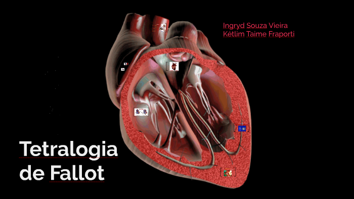 Tetralogia de Fallot by ketlim fraporti on Prezi