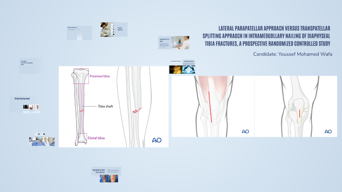 Comparative Study of Surgical Approaches in Tibial Fractures by youssef ...